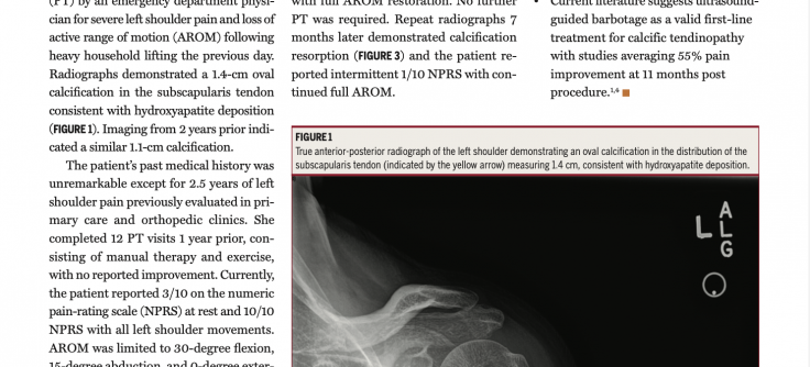 Barbotage of Subscapularis Calcific Tendinopathy 2024 - Spinal ...